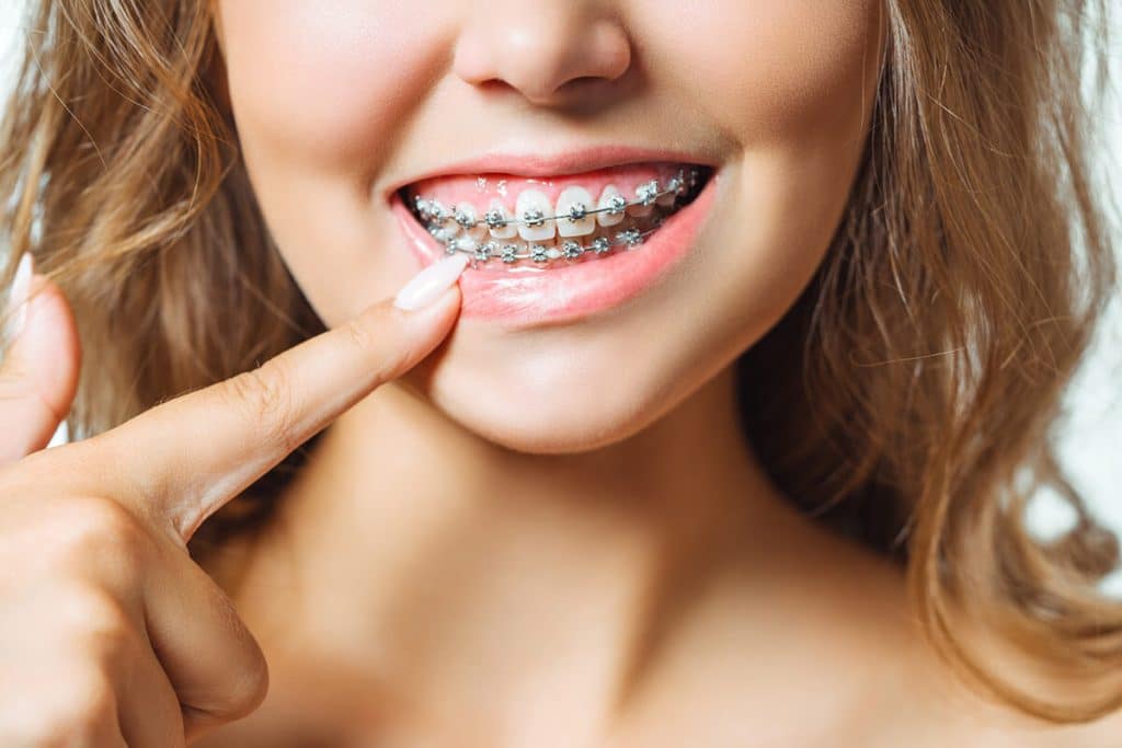 How Quickly Do Braces Close Gaps? – Greater Hartford Orthodontics